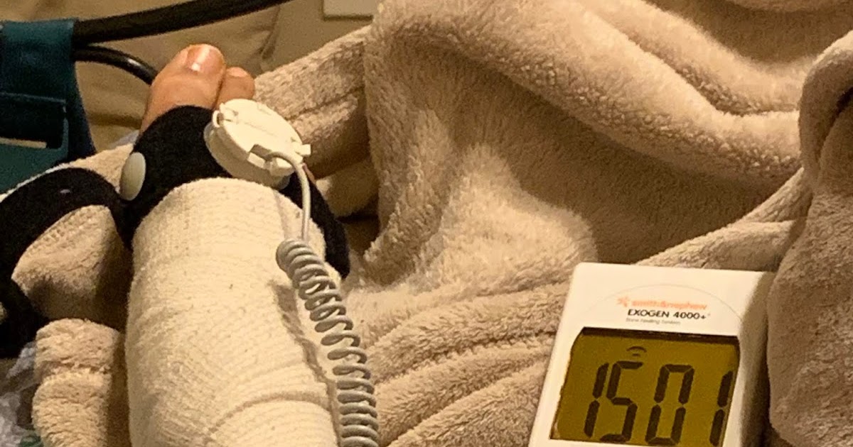 All About My 1st MPJ Foot Fusion: Using a Bone Stimulator for Recovery