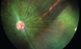 Le Cerveau de l'Enfant et de l'Adolescent: L'Optogénétique – La ...