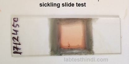 Sickle Cell क्या है | Sickling Test कैसे करते है – ( Slide Method ...