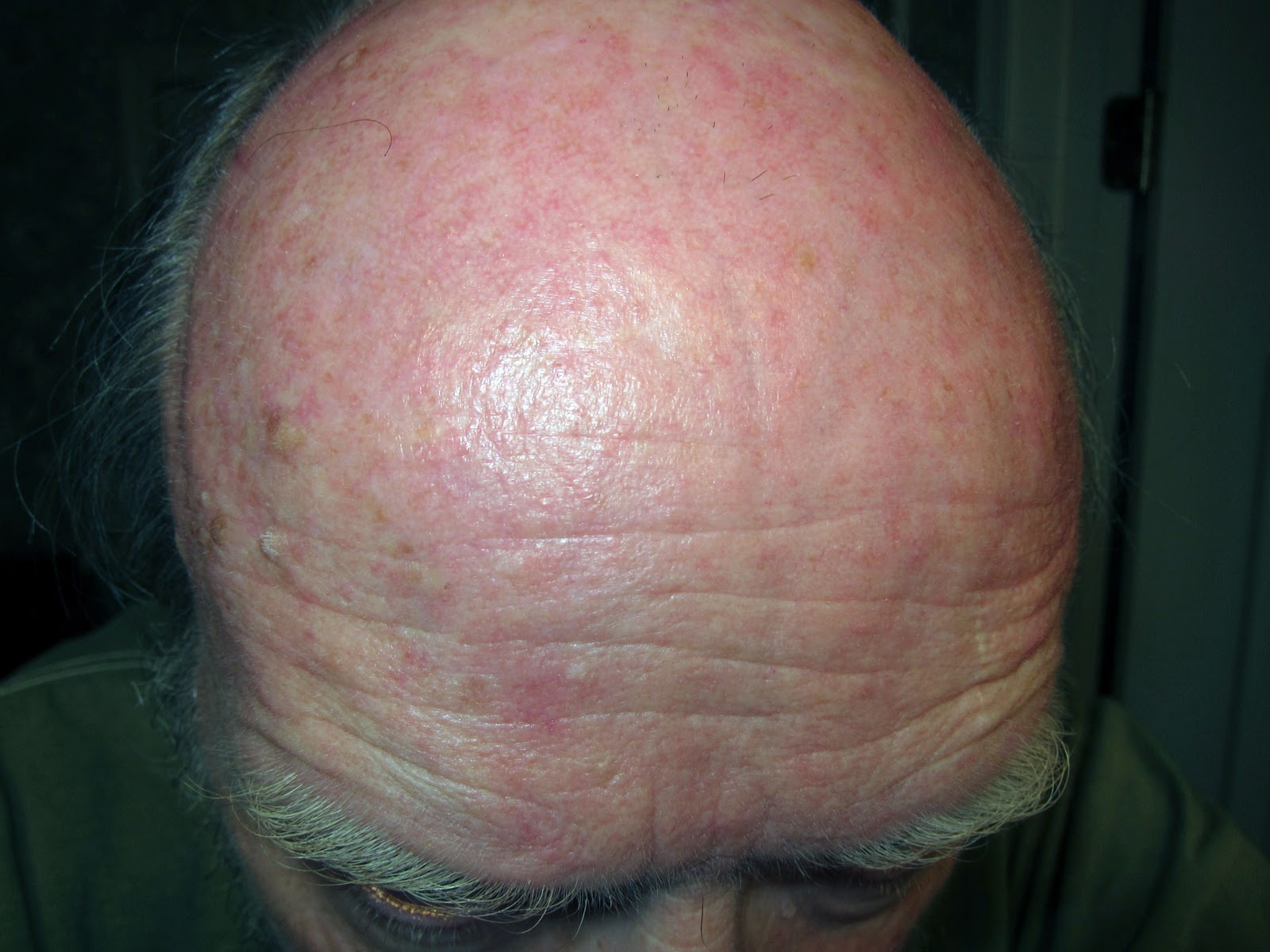 Efudex - Round Two: October 2011