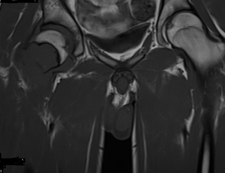 Femoral Neck-Aneurysmal Bone Cyst - Sumer's Radiology Blog