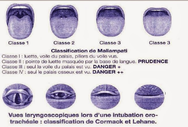 FACTEURS PRÉDICTIFS D'INTUBATION DIFFICILE