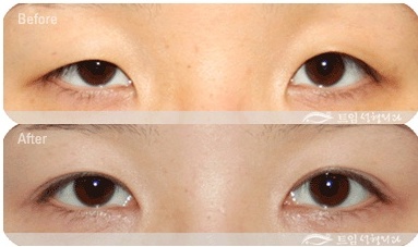 Teuim Aesthetic Plastic Surgical Clinic Dr.Kwon: Difference of eyes ...