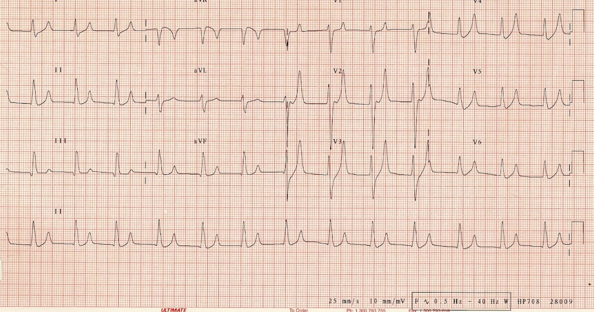 ECG Class - Keeping ECGs Simple: Serum Potassium and The Heart
