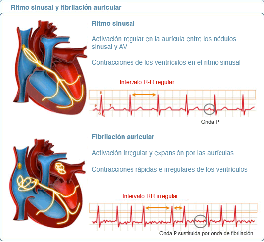 FUNDAMENTOS DE ELECTROCARDIOGRAFIA : ARRITMIA CARDIACAS COMUNES