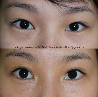 The Art & Science of Beauty : The Durable Non-cutting Double Eyelid ...