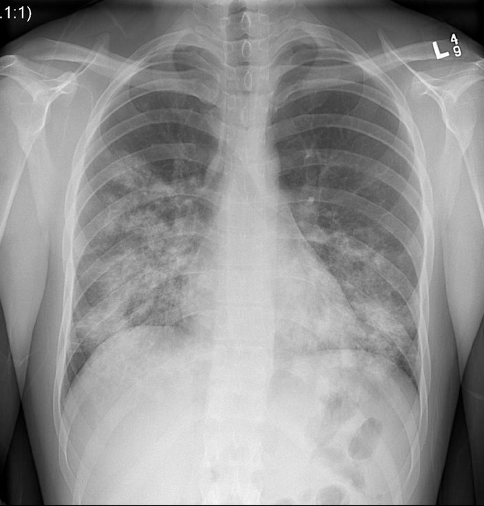 Curso Patologia B 2013: Bronquitis crónica