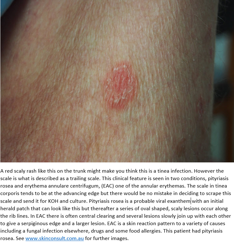 Consultations in Dermatology: Pityriasis rosea