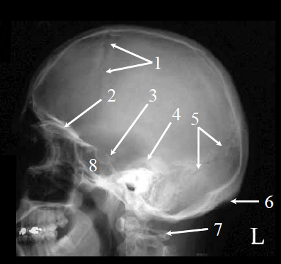 Medical Imaging Technology: Skull Radiography- Lateral and PA views