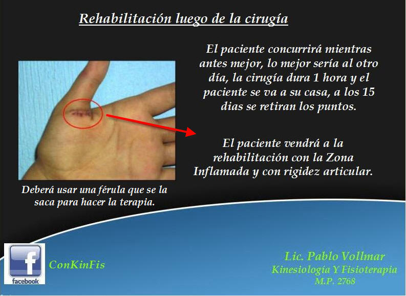 Consultorio Privado de Kinesiología y Fisioterapia: Dedos en Gatillo o ...