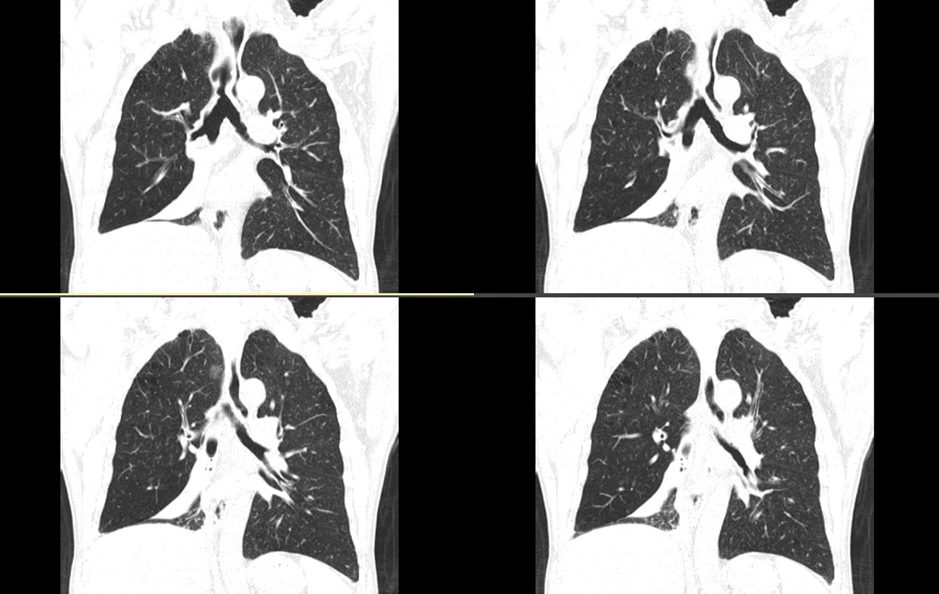 CXR 胸部x光判讀 right lower lobe (RLL) and right middle lobe (RML) collapse