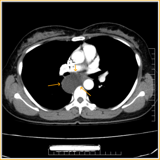 Bronchogenic Cyst-CT - Sumer's Radiology Blog