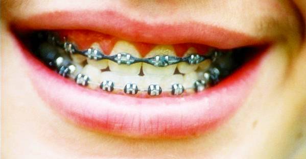 Happynezz Shop: Behel BracKet asLi Motif power chain