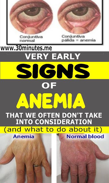 7 Signs of Anemia That You May Not Be Aware Of And How To Treat It ...