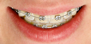 Quirky Things I've Seen...: The Fake Braces Company