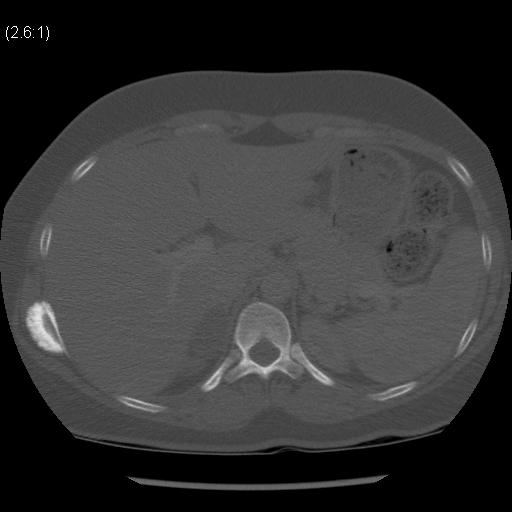 Post Gad: Rib Periosteal OsteoSarcoma