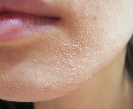 Negyven Felett: Száraz bőr és a tél