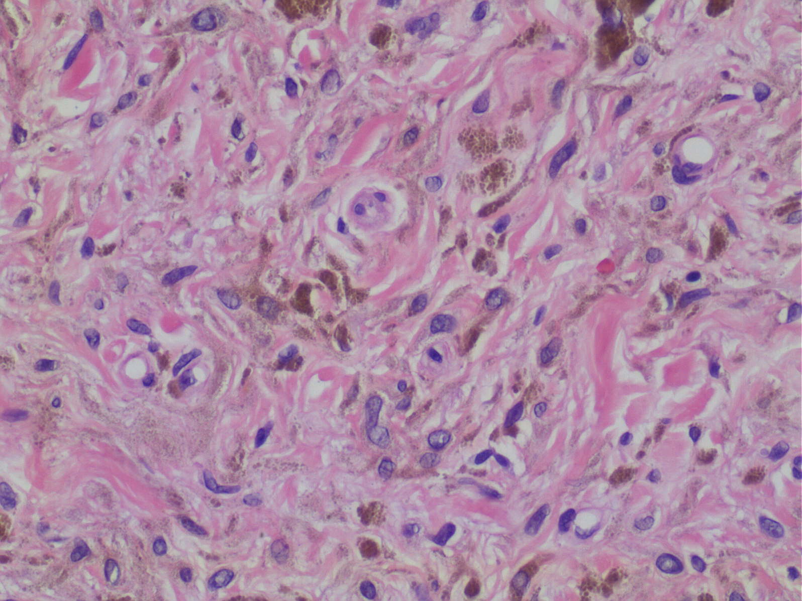 Histopatologando - Atlas do HCFMRP-USP: Nevo azul