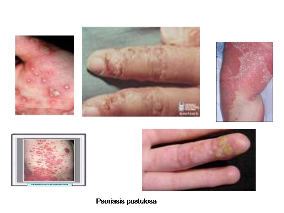 Psoriasis