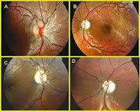 SALUD Y MEDICINA: La Neuromielitis Optica