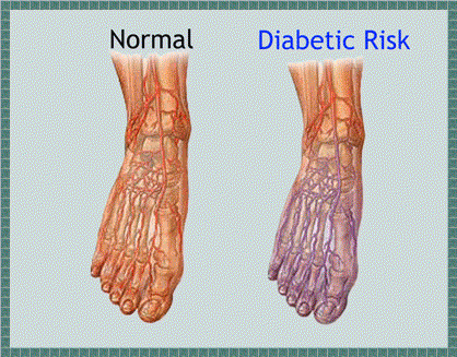 Deepali Phadnis: Diabetic Foot Care