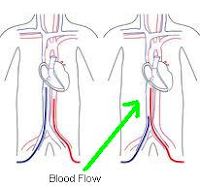 Impact of lack of blood flow