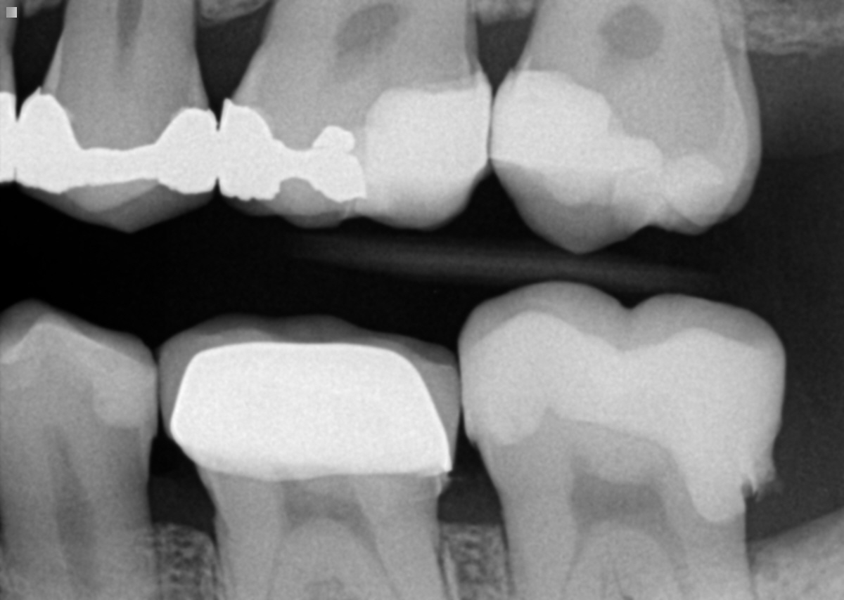 sweet tooth: distal decay on 2nd molars.