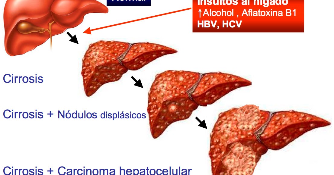 ALTERACIONES DE LA REPLICACIÓN: CARCINOMA HEPATOCELULAR ~ Biología ...