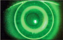 Orthokeratology: The Basic Design - Eyedolatry