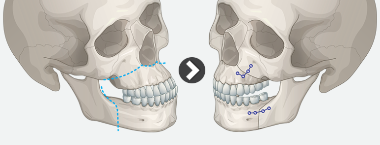 ID Hospital Korea: Curious about the difference between double jaw ...