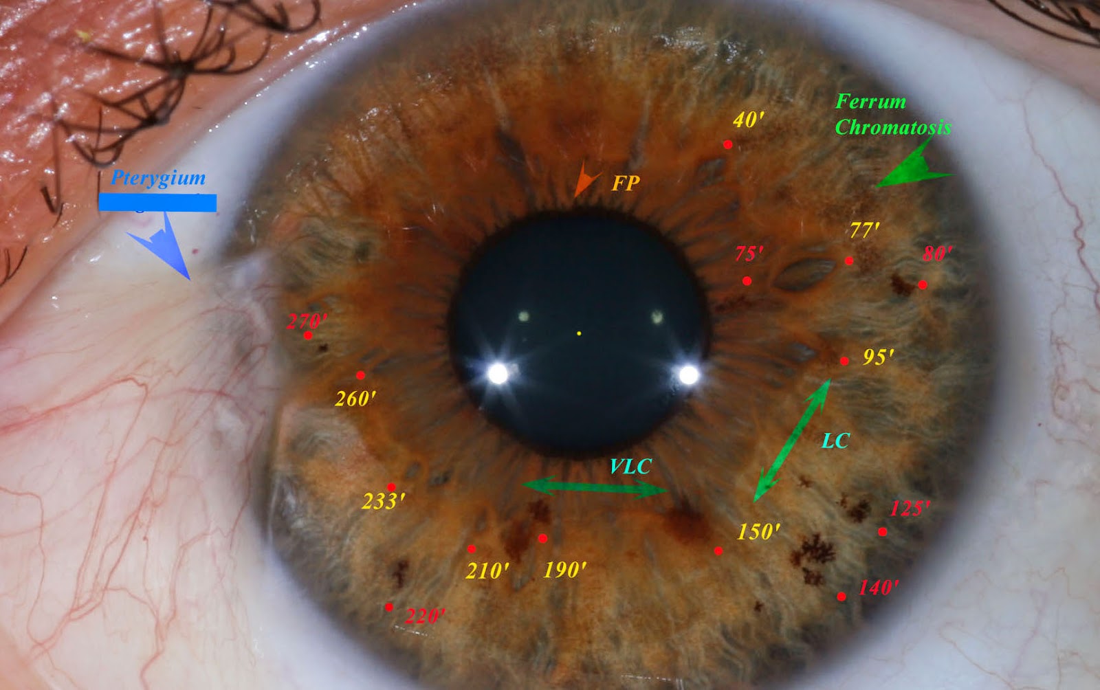 Modern & Multidimensional Iridology: Orange & Brown Pigments at ...