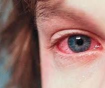 ¿Cómo curar OJOS ROJOS? Receta casera - DON SOPLÓN