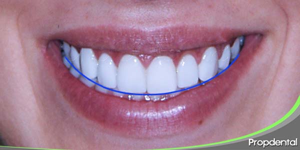 Análisis de sonrisa : Análisis de sonrisa