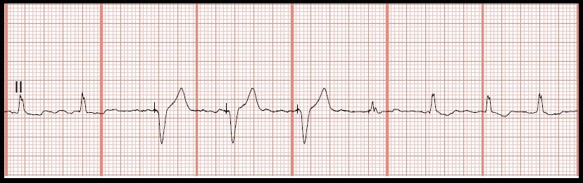 EKG Rhythm Strip Quiz 136