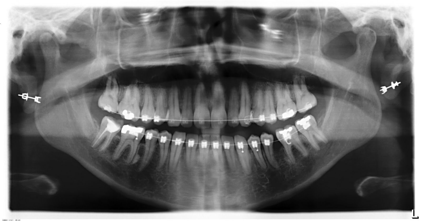 Jenn's Jaw Surgery: Before pics