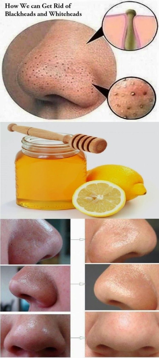How To Remove Blackheads From Your Nose Fun And Fashion Blog how-to-remove-blackheads-from-your-nose-fun-and-fashion-blog