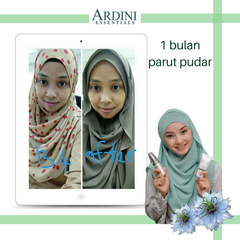 Jerawat mula kecut dan parut pudar dalam masa 2 bulan. Saya perkenalkan ...