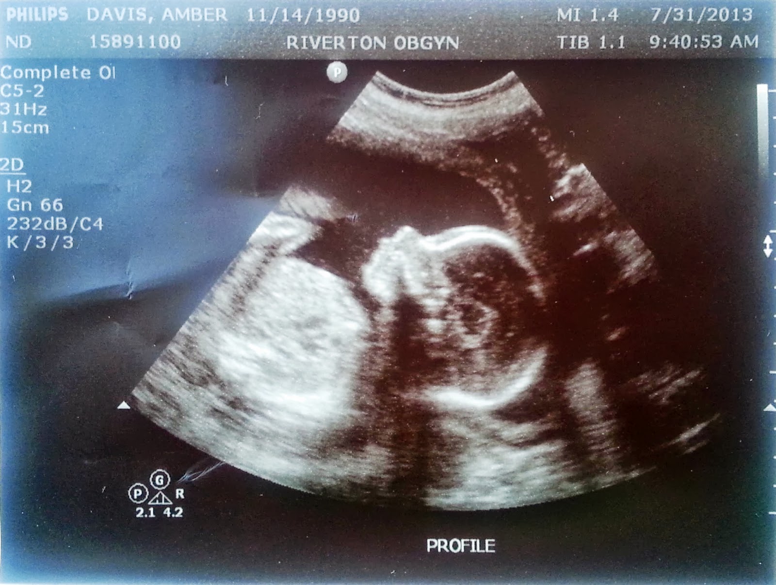 Amber Josh 20 Week Anatomy Scan Amber Josh 20 Week Anatomy Scan