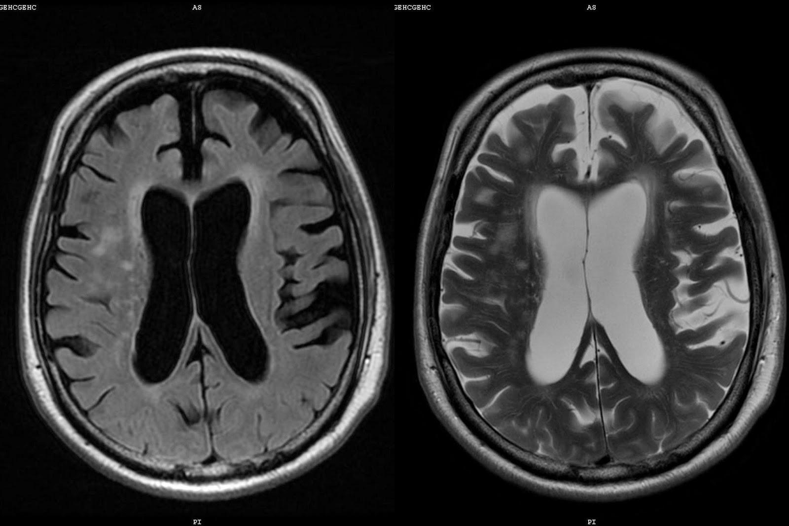 Dr Balaji Anvekar FRCR: Role of MR Csf flow study in NPH