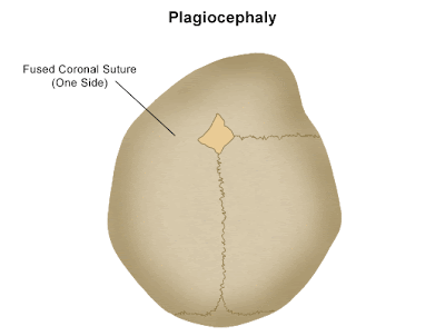 Oh, Boy!: craniosynostosis story