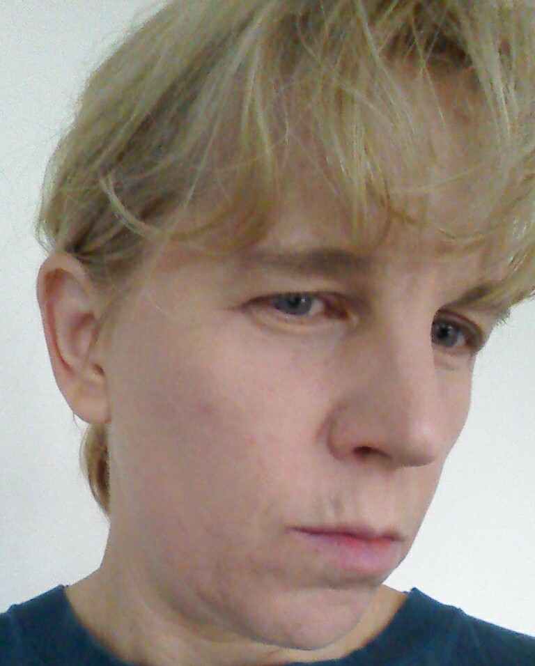 The Photo Below Shows My Face Without Any Makeup Those spots And the-photo-below-shows-my-face-without-any-makeup-those-spots-and