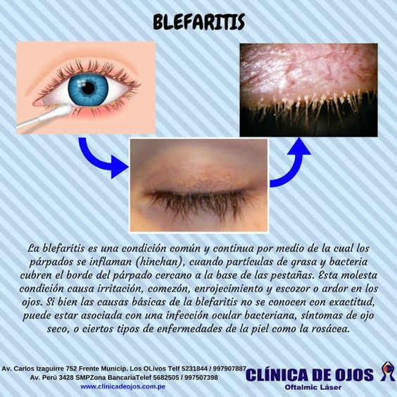 Clínica de Ojos Oftalmic Láser: BLEFARITIS