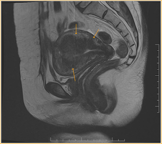 Adenomyosis-MRI - Radiology Imaging