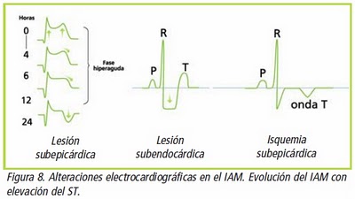 Medicina: Infarto Agudo del Miocardio
