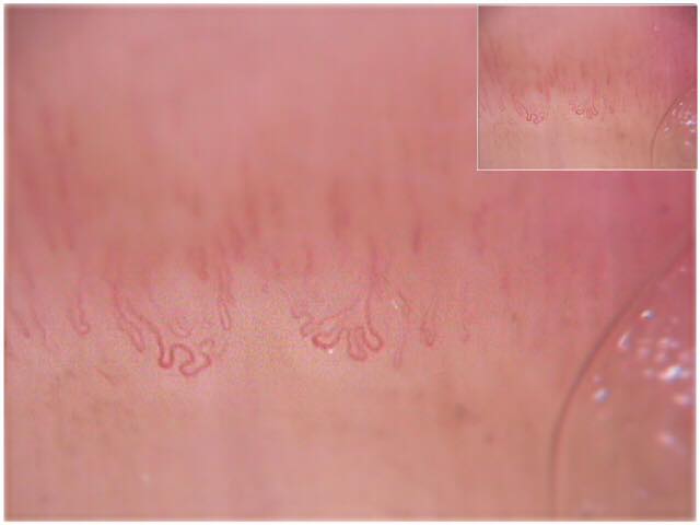 DERMATOSKOPİ ve TRİKOSKOPİ: DERMATOSKOPİK KAPİLLEROSKOPİ