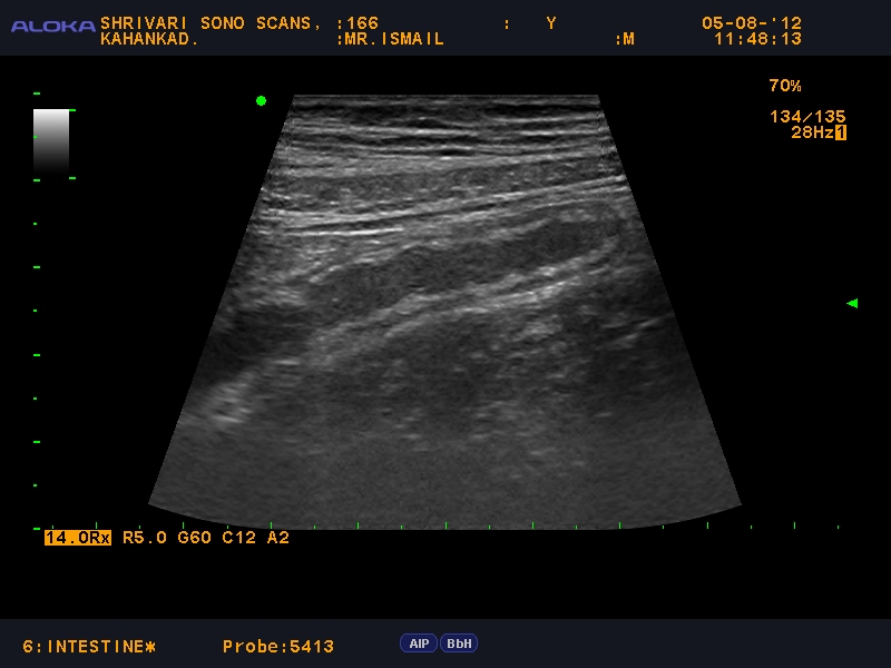 Shrivari Sono Scans: Ultrasonography for the diagnosis of appendicitis..