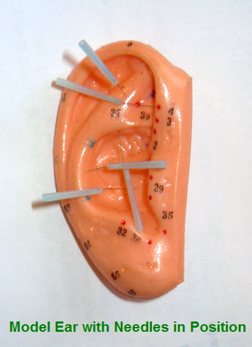 Milwaukee Veterans Acupuncture - Military Stress Recovery Project: WHAT ...