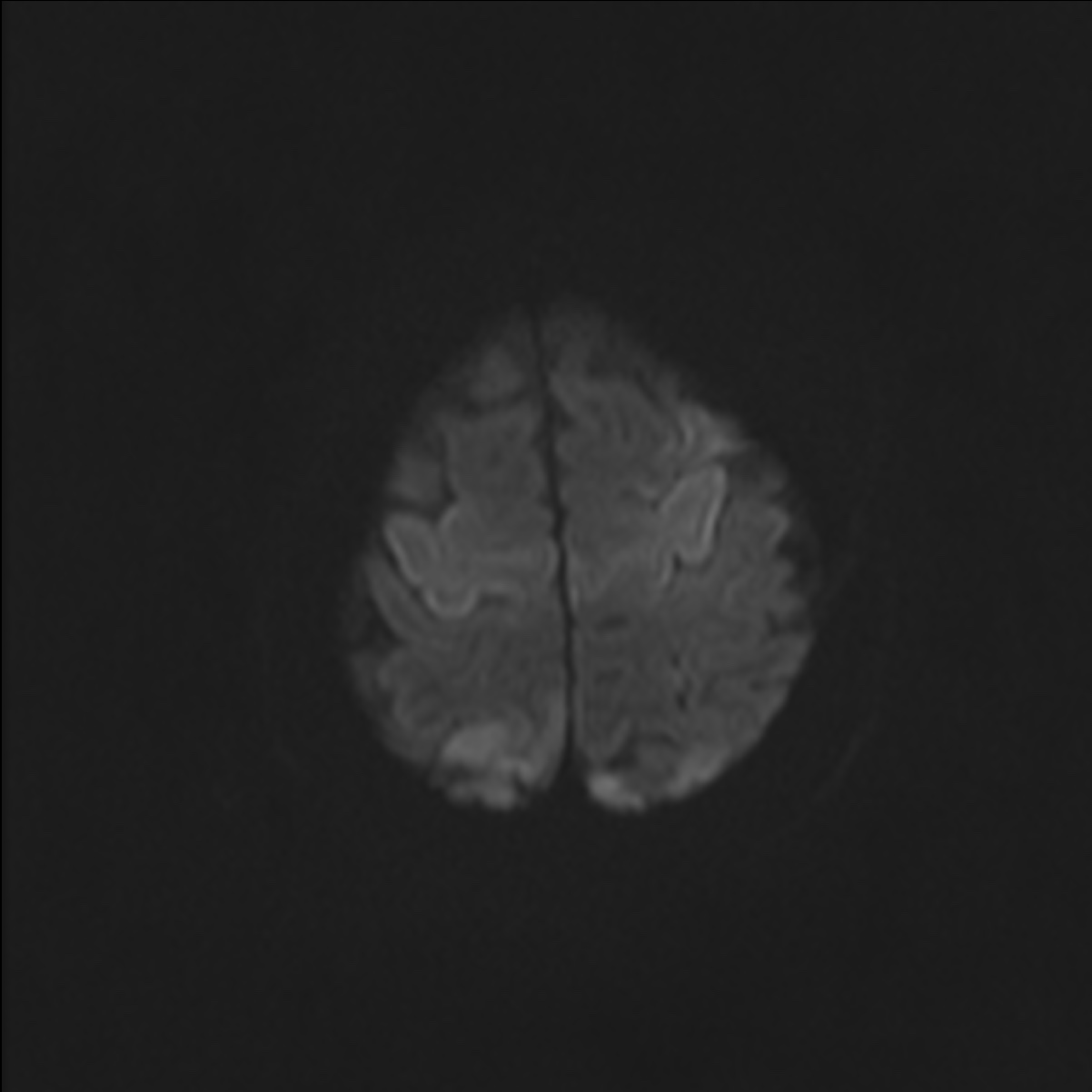 Ultimate Radiology : Hypoxic-Ischemic Brain Injury in a post cardiac ...