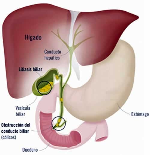 MEDICINA: COLICO BILIAR