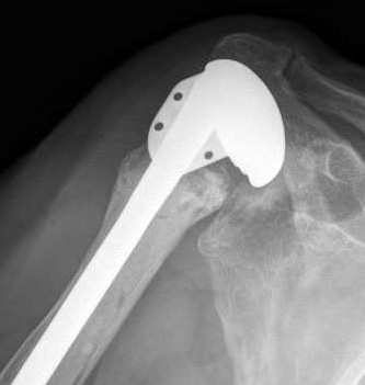 UW Shoulder and Elbow Academy: The dislocated reverse total shoulder